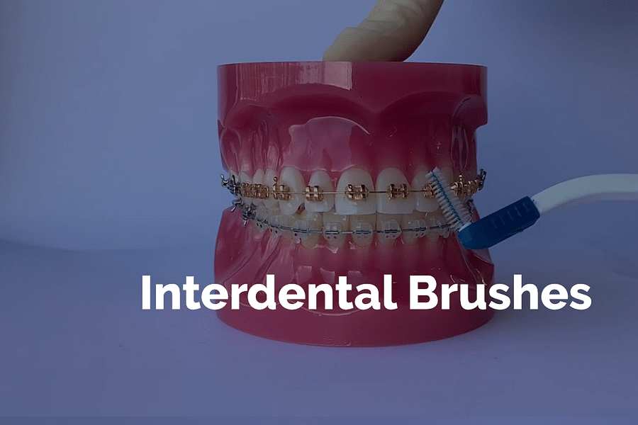 The Intersection Of Art And Orthodontics How Custom Braces Are